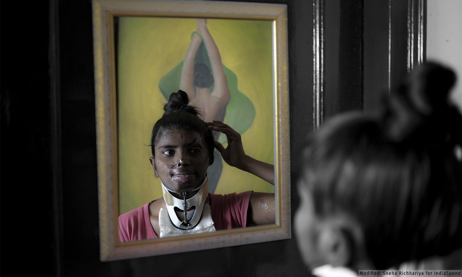 Scare of the Scars: Acid Attacks and Skin Scarring