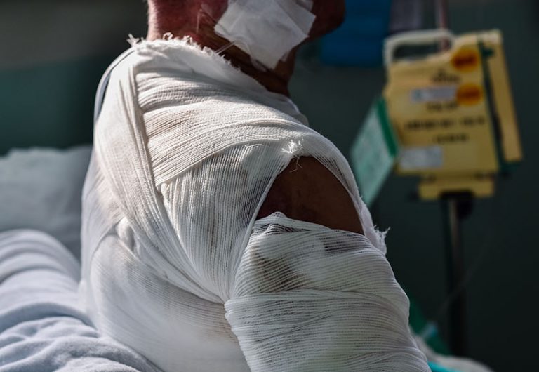 India's Burn-Care Management Suffers From Lack Of Data, Beds, Trained ...